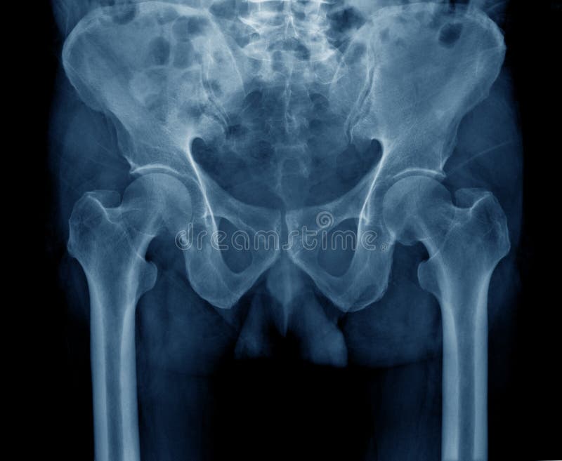 Heup en bekkenbeen stock afbeelding. Image of radiografie - 115922161