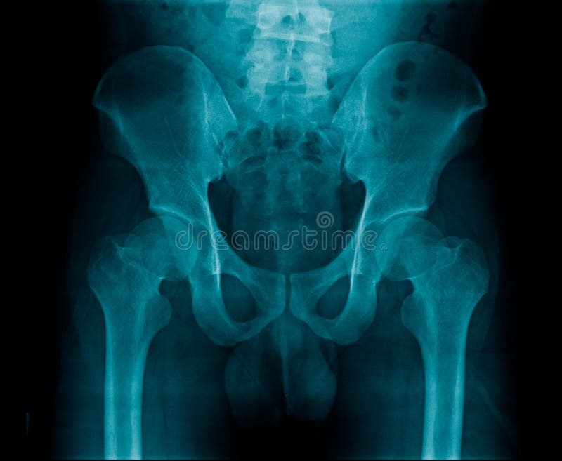 Heup en bekkenbeen stock afbeelding. Image of radiografie - 115922161