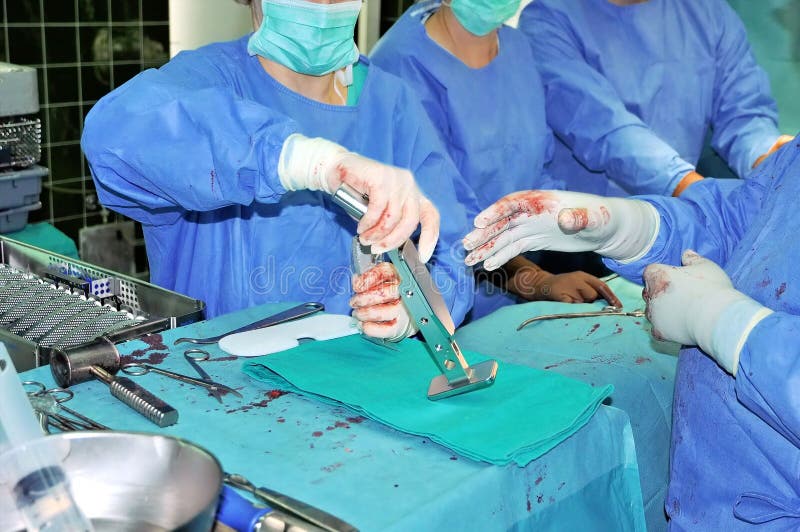 Heupvervanging stock afbeelding. Image of binnen, artritis - 75592815