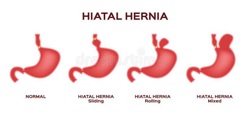 Hiatale Hernia. Hiatale Hernia En Normale Anatomie Van De Maag Vector ...