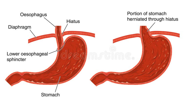 Hiatus hernia stock vector. Illustration of stomach, anatomy - 12762379
