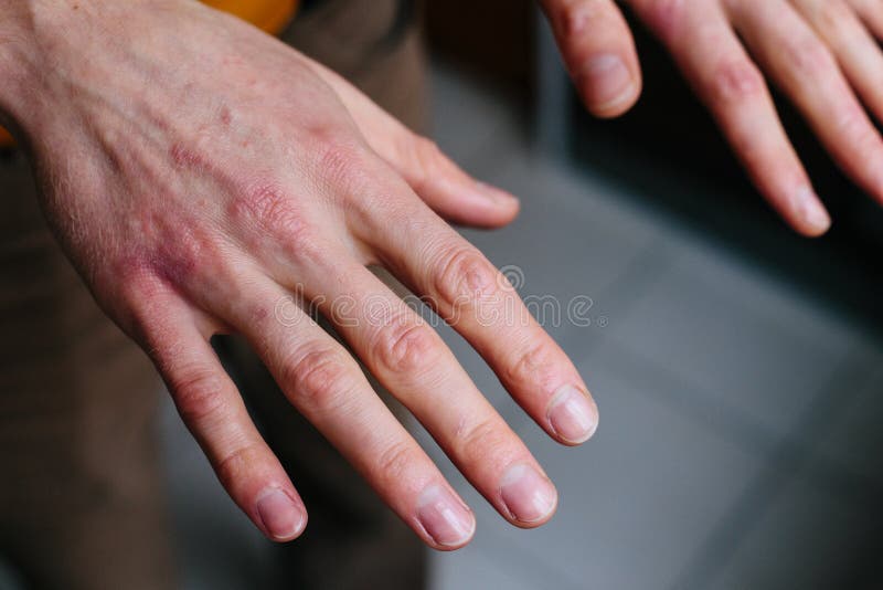 Psoriasis On Knuckles