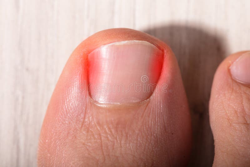 Close-up Sore Toe Nail stock image. Image of problem - 148995493