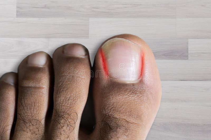 An Elevated View of Sore Toe Nail on Floor Stock Photo - Image of ...