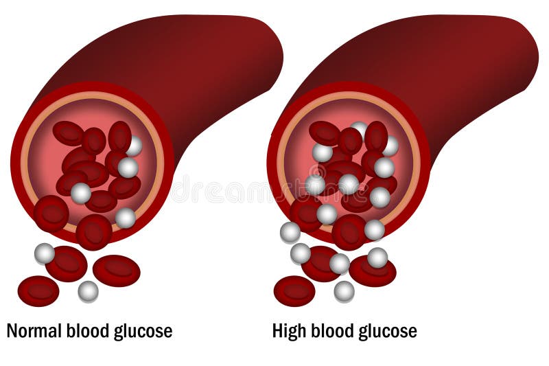 High Blood Glucose Isolated with White Background Stock Illustration ...