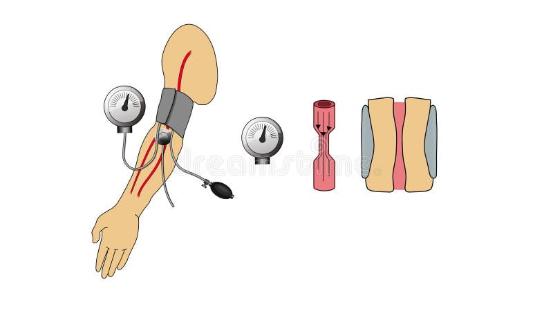 High Blood Pressure Concept , Measuring Blood Pressure, White ...