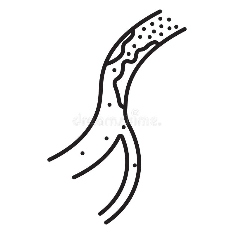 High Cholesterol or Atherosclerosis Icon. Artery Blocked by Cholesterol ...