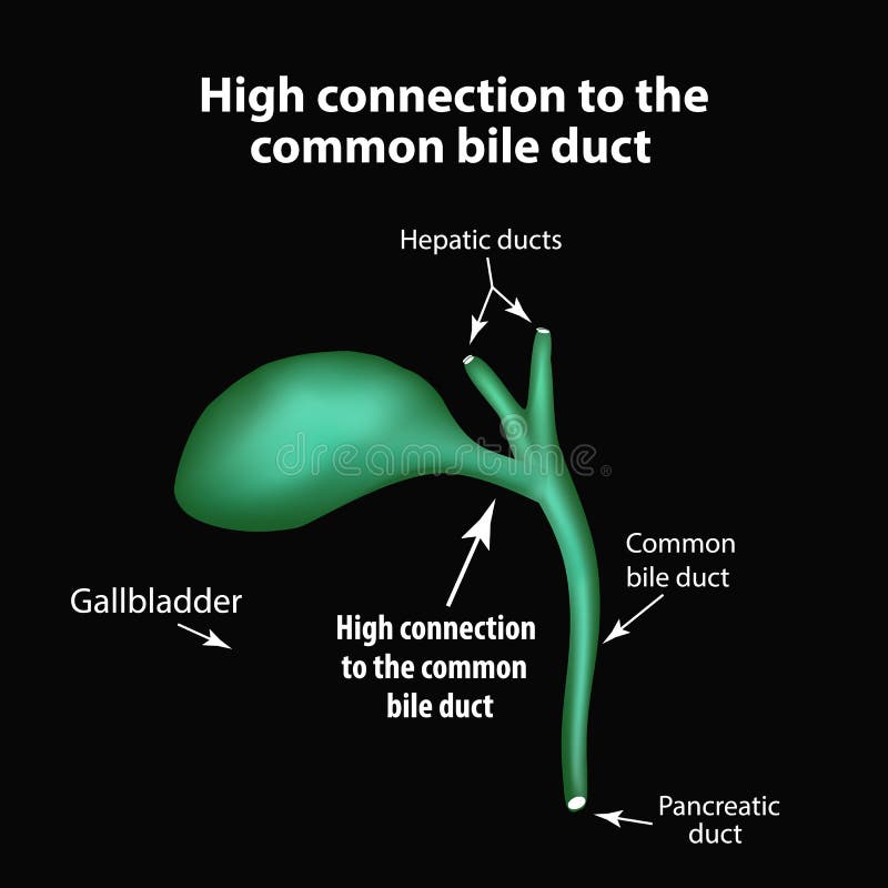 High Connection To the Common Bile Duct. Pathology of the Gallbladder ...