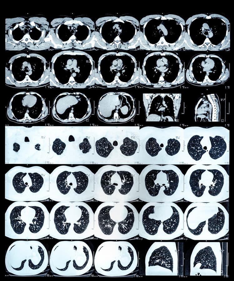 High Resolution Computed Tomography Images of a Normal Thorax in Axial ...