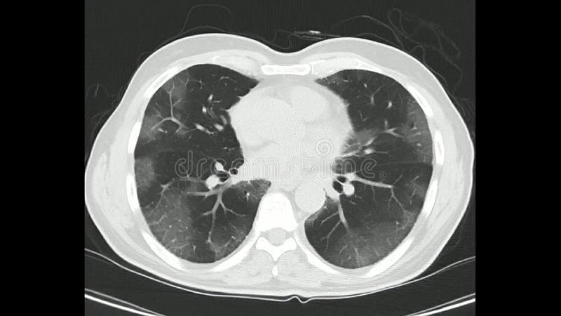 Computed Tomography of the Chest High Resolution CT Chest in a ...