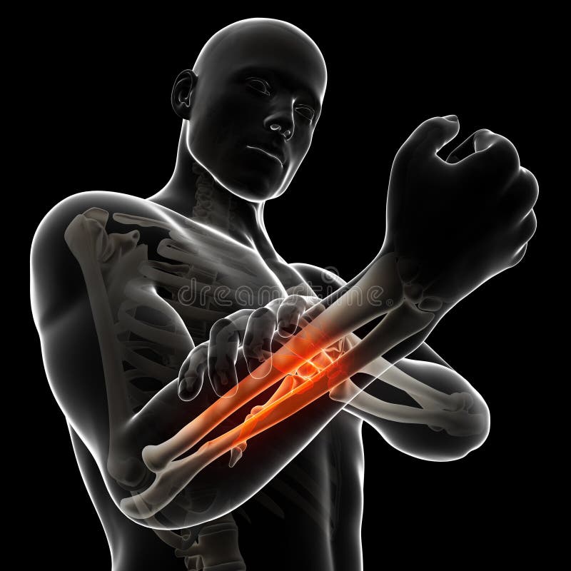 Highlighted arm stock illustration. Illustration of injury - 30722395