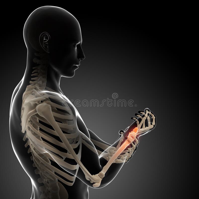 Highlighted arm stock illustration. Illustration of osteoarthritis ...