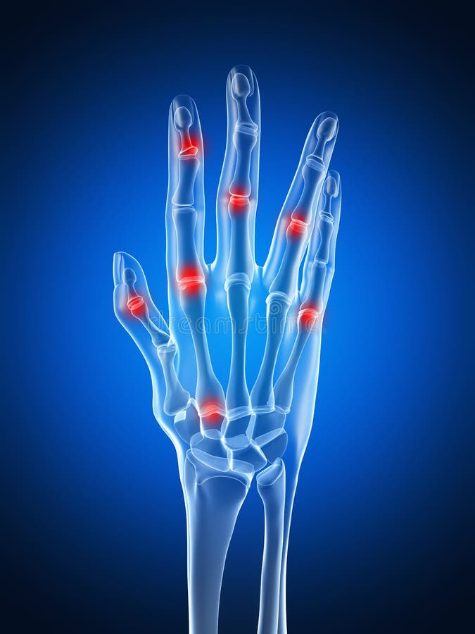 Highlighted arthritic hand stock illustration. Illustration of biology ...