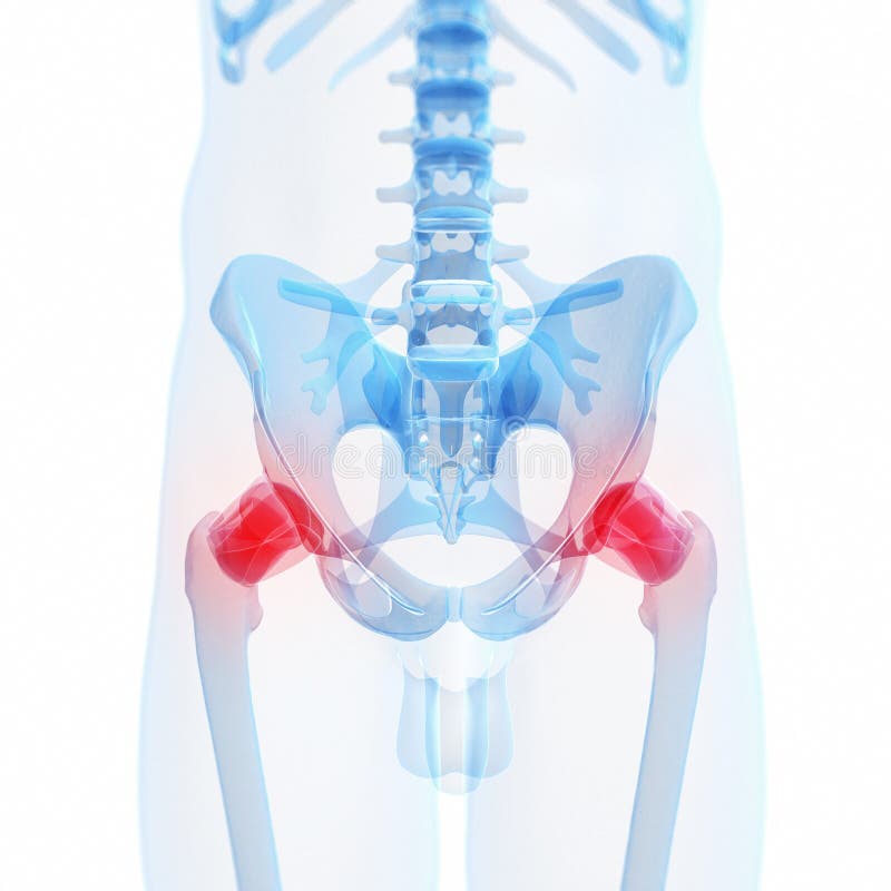 Highlighted hip joint stock illustration. Illustration of inlamed ...
