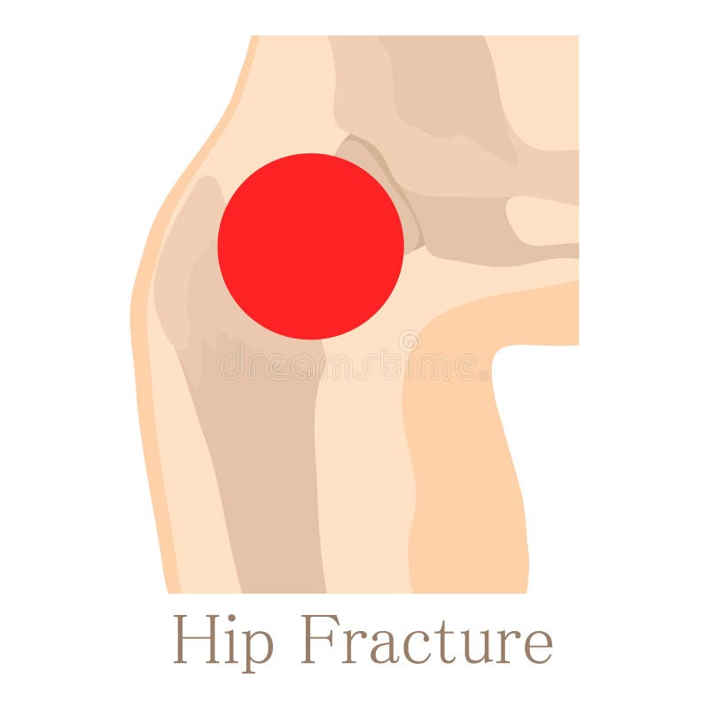 Hip Fracture Icon, Cartoon Style Stock Vector - Illustration of forearm ...