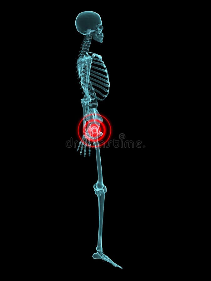 Hip joint inflammation stock illustration. Illustration of backbone ...
