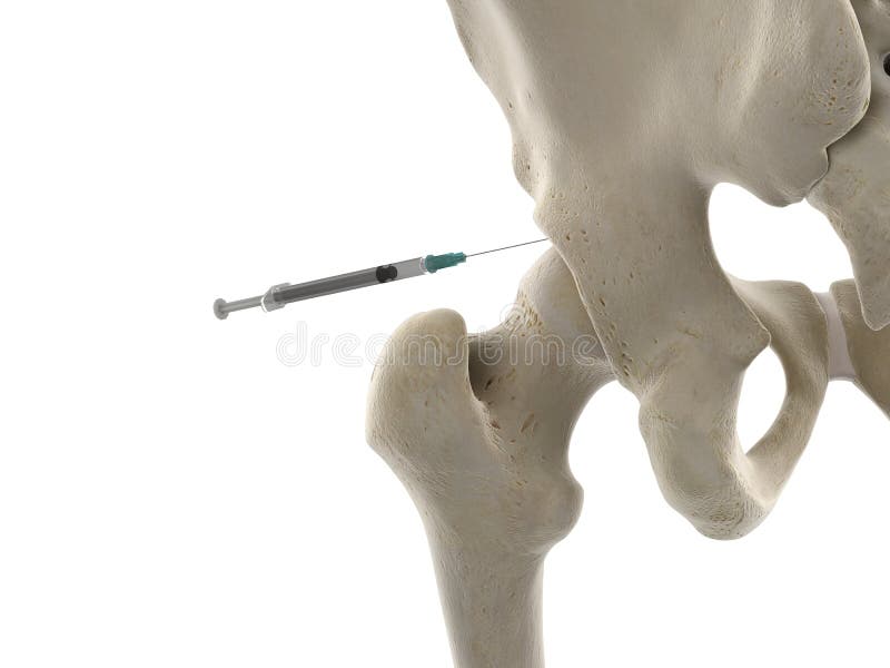 A hip joint injection stock illustration. Illustration of femur - 169374189