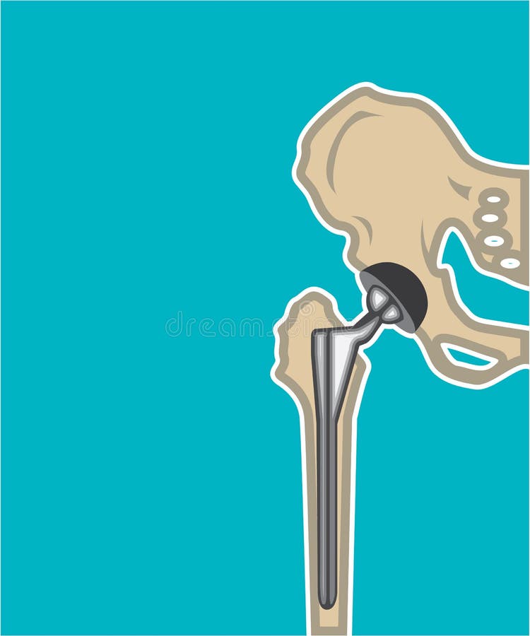 Artificial Joint Icon, Cartoon Style Stock Vector - Illustration of ...