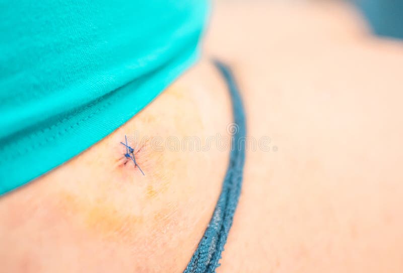 Hip and Leg with Wound and Stitches Showing Healing and Sterilization ...