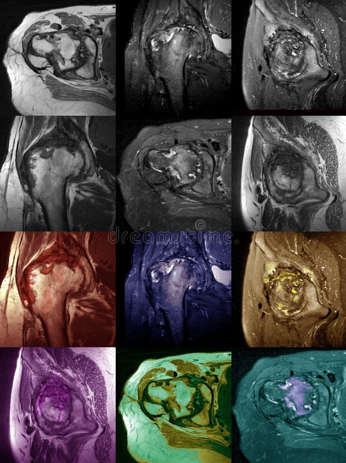 Osteoarthritis Hip and Knee, MRI Stock Photo - Image of bone, body ...