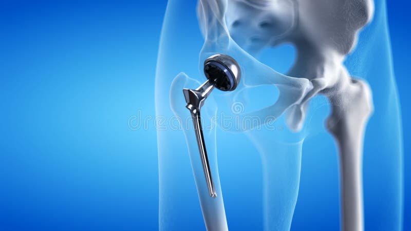 A hip replacement stock illustration. Illustration of pelvic - 137360353