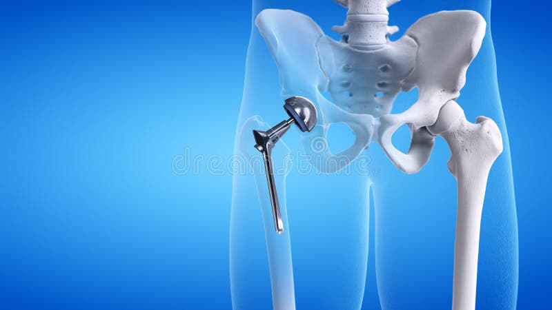 Hip replacement stock illustration. Illustration of orthopedic - 30724938