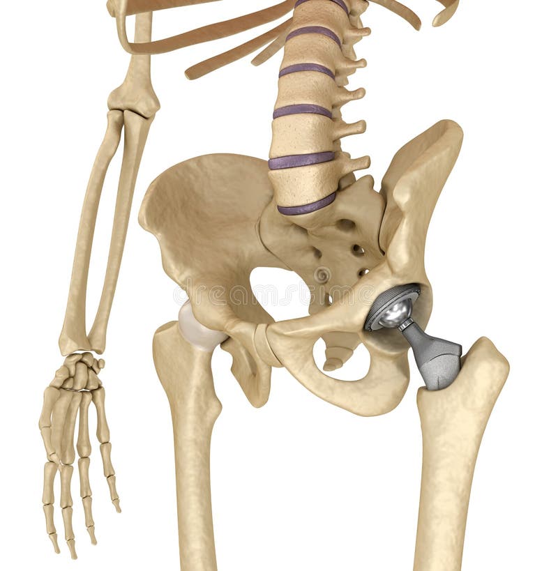 Hip Replacement Implant Installed in the Pelvis Bone. Medically ...
