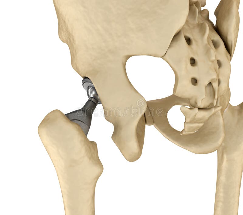 Hip Replacement Implant Installed In The Pelvis Bone. Medically ...