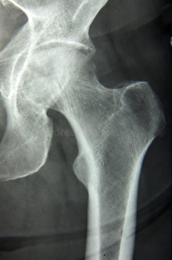 Hip Xray, Classic Radiography Stock Photo - Image of pelvis ...