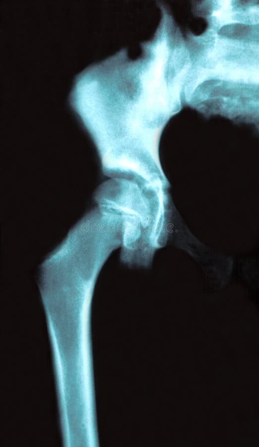 Hip Xray, Classic Radiography Stock Photo - Image of pelvis ...