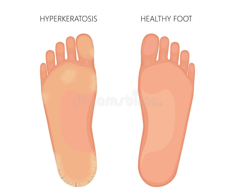 Hiperqueratosis plantar ilustración del vector. Ilustración de piel ...