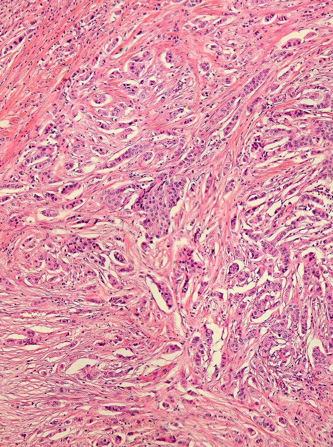 Histología Del Cáncer De Pecho Imagen de archivo - Imagen de salud ...