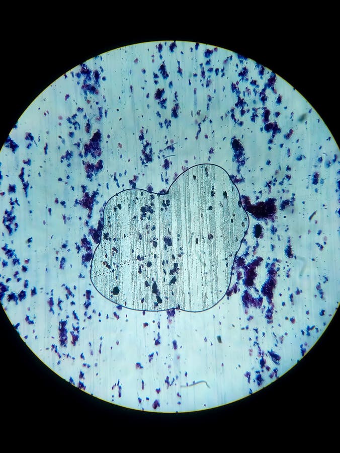 A Histological Slide of a Tissue Sample. Large Cell Lymphoma in the ...