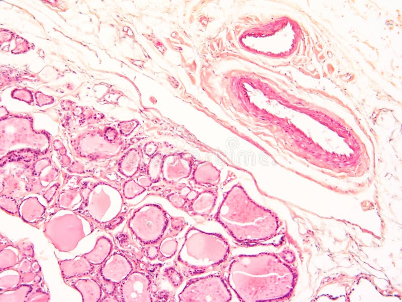 Human Thyroid Gland With Goiter Caused By Deficiency Of Iodine Under A ...