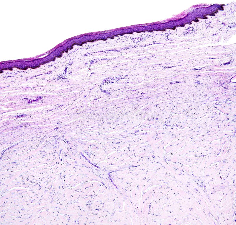 Histology of Human Tissue, Show Spleen Infarction at a Scarring Stage ...