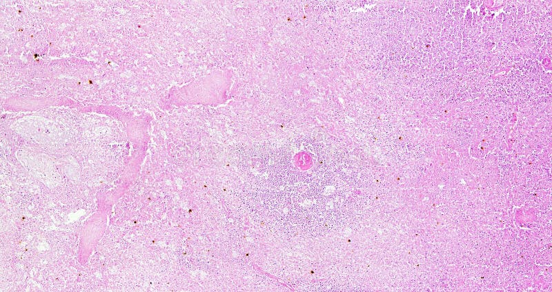Histology of Human Tissue, Show Spleen Infarction As Seen Under the ...