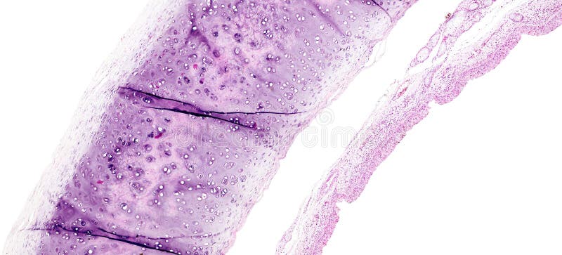 Histology of Human Tissue, Show Tracheitis As Seen Under the Microscope ...