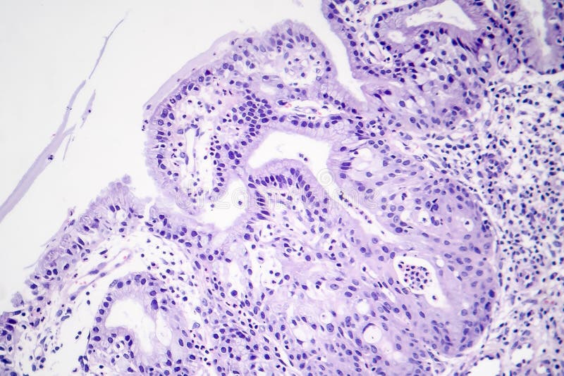 Histopathologie Des Polypes Nasaux Photo stock - Image du épithélium ...