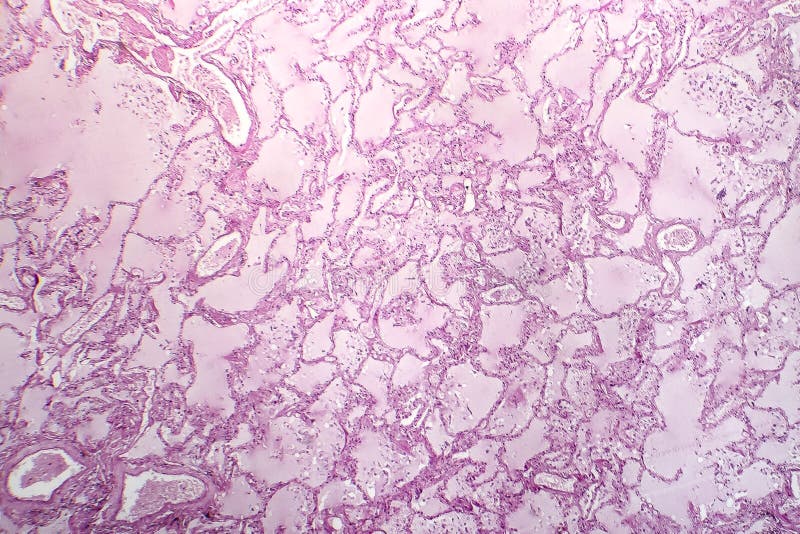 Acute pulmonary edema stock photo. Image of cell, photomicrograph ...