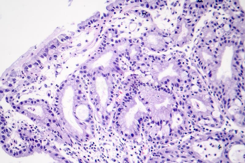 Histopathology Av Nasala Polyper Fotografering för Bildbyråer - Bild av ...