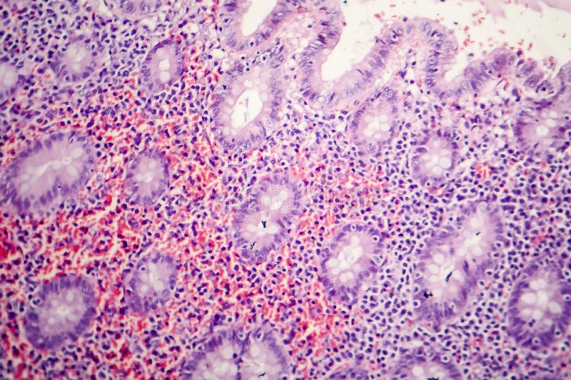 Histopathology of Chronic Appendicitis Stock Photo - Image of ...