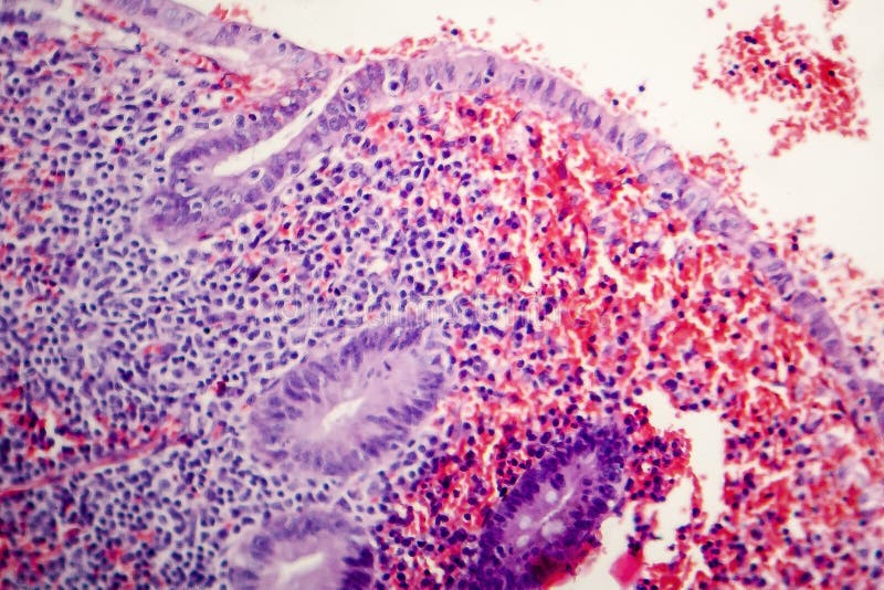 Histopathology of Chronic Appendicitis Stock Photo - Image of cell ...