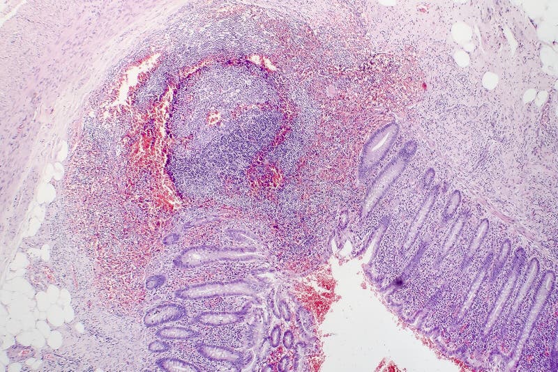 Histopathology of Chronic Appendicitis Stock Photo - Image of cell ...
