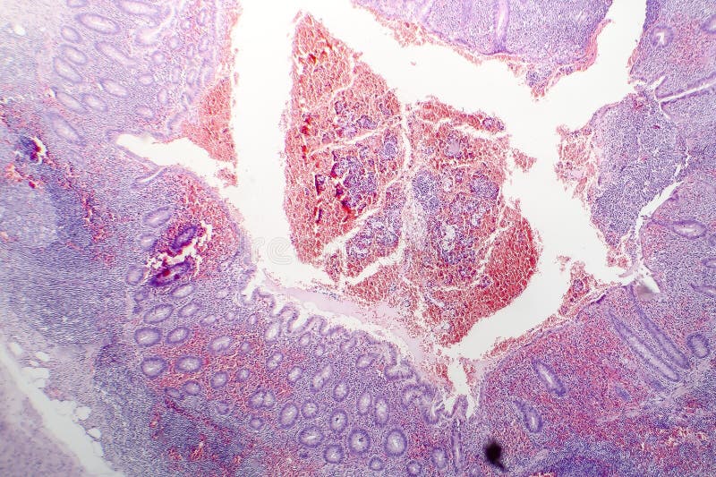 Histopathology of Chronic Appendicitis Stock Photo - Image of ...