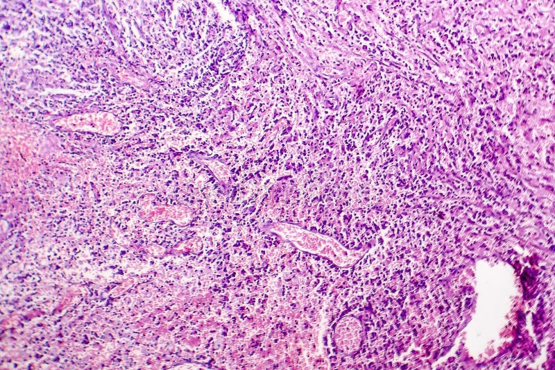 Histopathology of Chronic Appendicitis Stock Photo - Image of cell ...