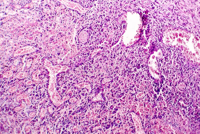 Histopathology of Chronic Cholecystitis Stock Photo - Image of ...