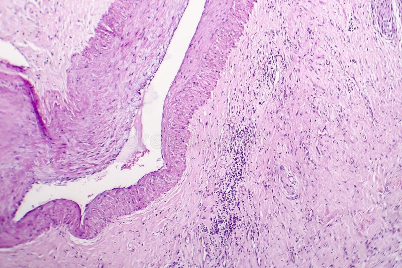Histopathology of Chronic Appendicitis Stock Photo - Image of cell ...