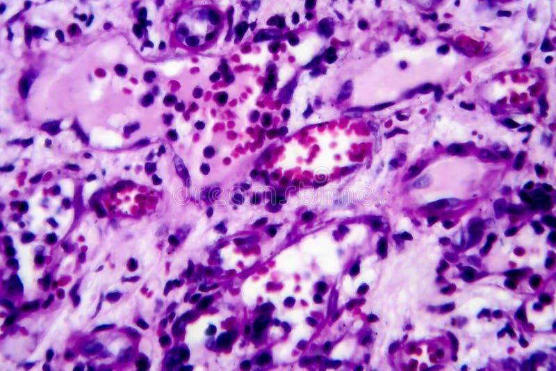 Histopathology of Interstitial Nephritis Stock Image - Image of tissue ...