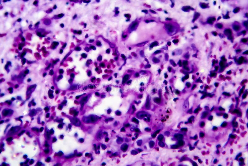 Histopathology of Interstitial Nephritis Stock Photo - Image of ...