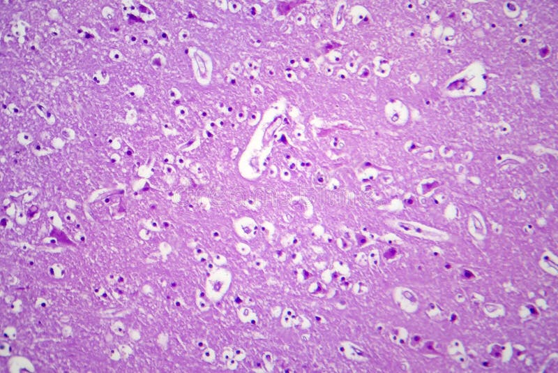 Histopathology of Japanese Encephalitis, Light Micrograph Stock Photo ...